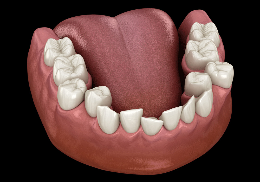 Crowding & Spacing Correction - Paladin Dental - Dentist in Fresno, CA